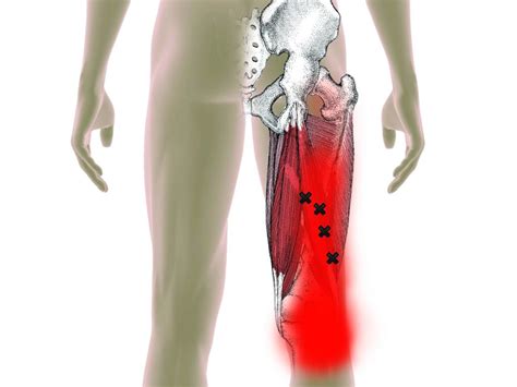 Hamstring Trigger Points