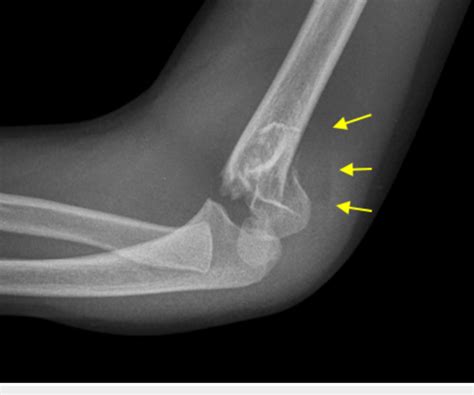 Lateral X Ray Elbow Projection Of The Patient In Figure 1 Download