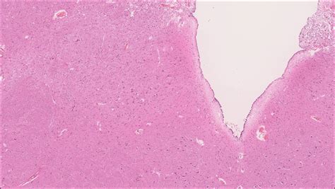 Brain Medulla NUS Pathweb NUS Pathweb