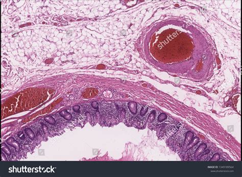 Surgical Pathology Show Section Subtotal Colectomy Stock Photo Shutterstock