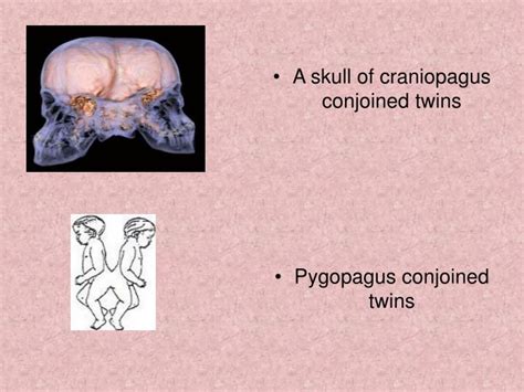 Ppt Conjoined Twins Powerpoint Presentation Id 1245222