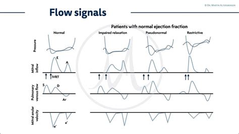 〖echocardiography〗 Flow Signals Mitral Valve Inflow And Tissue Doppler