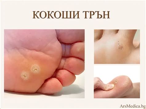 Кокоши трън брадавица по стъпалото Arsmedica Bg