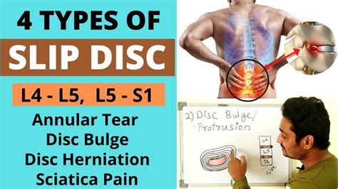 Slip Disc Herniation Bulging Disc Annular Tear At L4 L5 S1 Slip