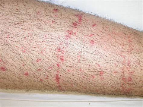 Petechiae Pictures Causes Diagnosis Treatment And Cure
