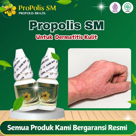Jual Propolis Sm Obat Dermatitis Seboroik Perional Iritasi Kulit Gatal