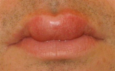 Swollen Lips Causes Treatment Pictures Remedies