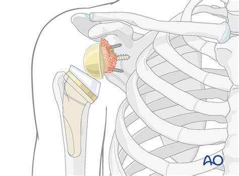 Revision Of An Anatomic All Polyethylene Glenoid Component For Glenoid