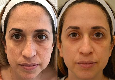 Bbl Photofacial Broadband Light Facial Procedure New Jersey