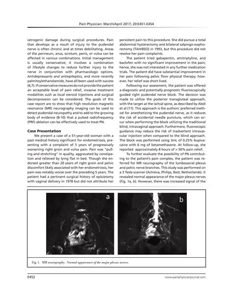 Pulsed Radiofrequency Ablation Of Pudendal Nerve For Treatment Of A Case Of Refractory Pelvic