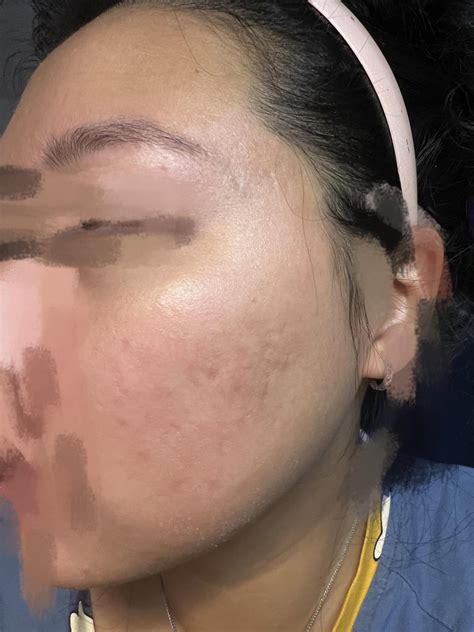 Tretinoin 0025 6 Months Rtretinoin