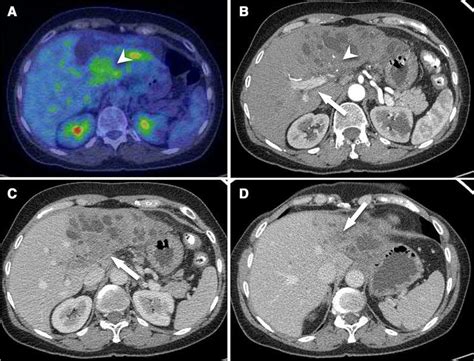 61 Year Old Female With Biopsy Proven Cholangiocarcinoma And Portal