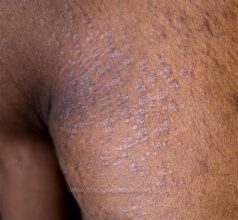 Hiv Rash On Black People