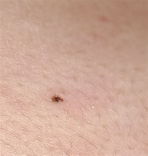 이거 혹시 흑색종인가요 아니면 점인가요 ㅣ 궁금할 땐 아하