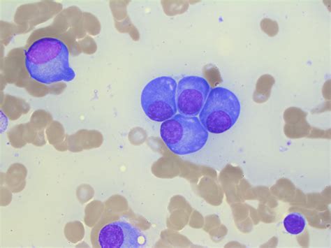Plasma Cell Neoplasm Mypathologyreportca