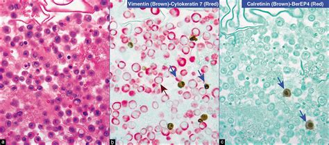 Immunocytochemistry Of Effusion Fluids Introduction To Scip Approach Cytojournal