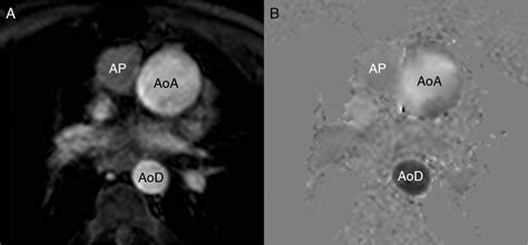 What Radiologists Need To Know About The Pulmonary Systemic Flow Ratio Qp Qs What It Is How