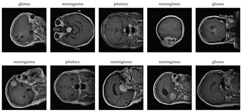 Gatransformer A Graph Attention Network Based Transformer Model To Generate Explainable