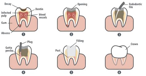 Root Canal Treatment At Rock Dental Wolverhampton