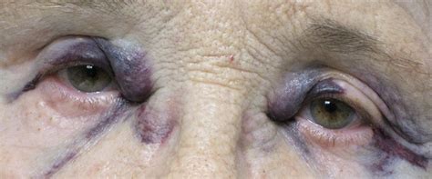 A 78 Year Old Woman With Nonpruritic Periorbital Purpura Around Her Eyelids