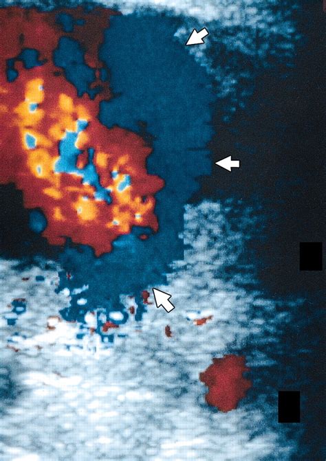 A Spectrum Of Doppler Waveforms In The Carotid And Vertebral Arteries Ajr