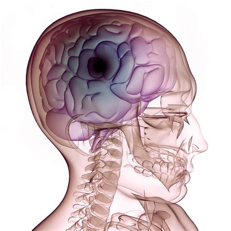 Stem Cell Therapy For Brain Injury Stemaid Institute
