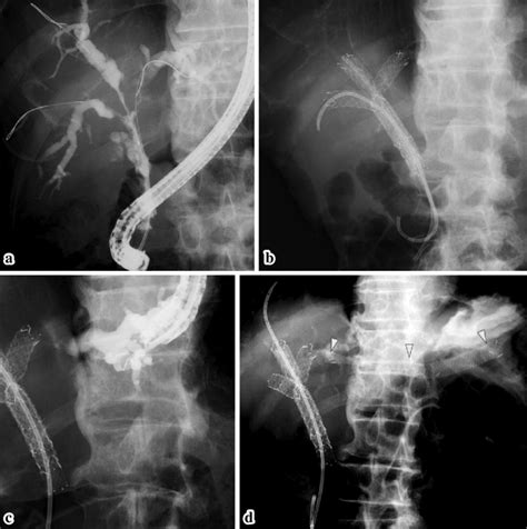 Figure2 Case Of Hilar Cholangiocarcinoma Patient 7 In Table 1 Download Scientific Diagram