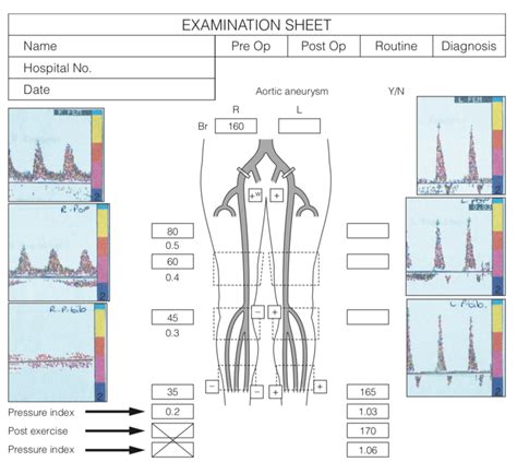 3 Segmental Arterial Waveforms May Help Discriminate The Functional