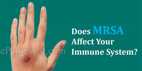 Does Mrsa Affect Your Immune System