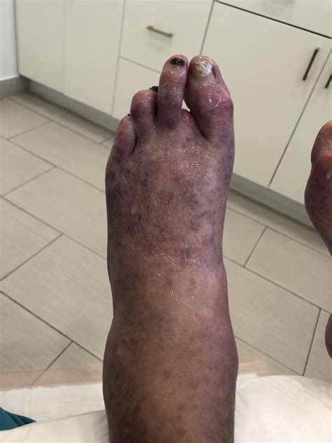 Icd 10 Code For Amputation Of Toes On Left Foot Sale Online