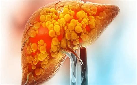 Men gan cao có nguy hiểm không dấu hiệu cảnh báo men gan cao