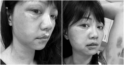 男友稱「第一次打女人」高嘉瑜信了 傷勢照曝光「眼睛瘀青膝蓋爆血」 社會 Ctwant
