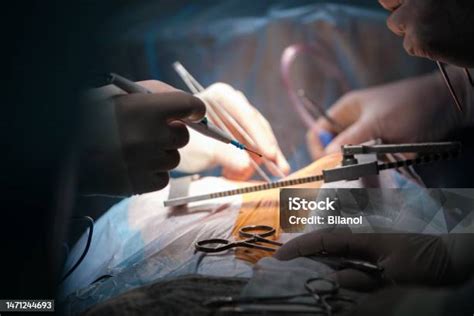 수술실에서 열린 심장 수술 중 환자를 수술하는 전문 의사의 손 클로즈업 의료 및 의료 개입 개념 3 명에 대한 스톡 사진 및 기타 이미지 Istock