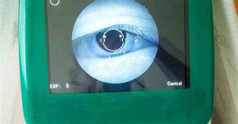 Fuchs Dystrophy Symptoms Diagnosis And Treatment Options