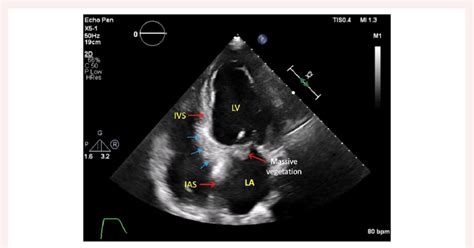 Transthoracic Echocardiography Four Chamber View On Admission During