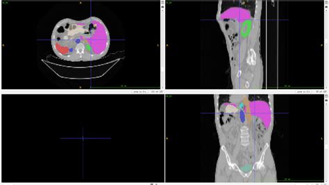 使用自己的数据集训练vnet导出静态图inferpy效果很差 · Issue 3298 · Paddlepaddlepaddleseg · Github