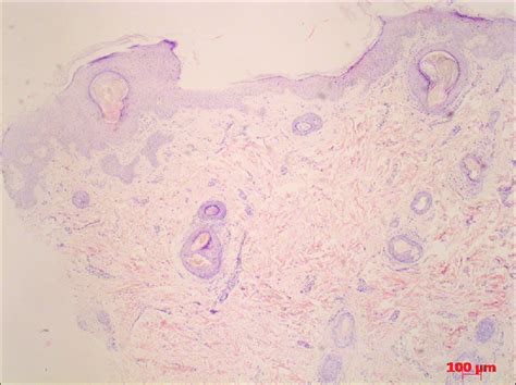 Follicular Plugging With Perifollicular And Perivascular Mild Download Scientific Diagram