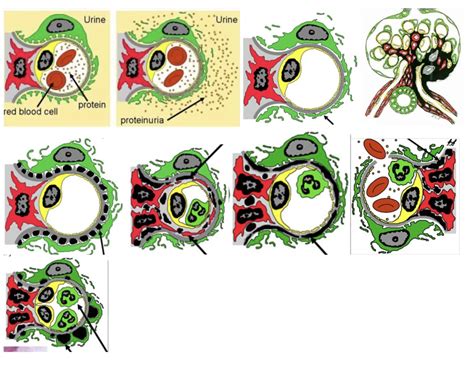 Glomerular Diseases Quiz