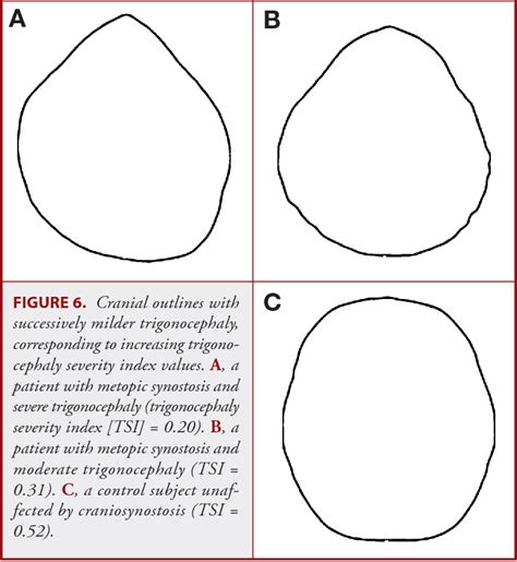 Mild Trigonocephaly
