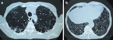 Combined Pulmonary Fibrosis And Emphysema Cpfe Thoracic Key