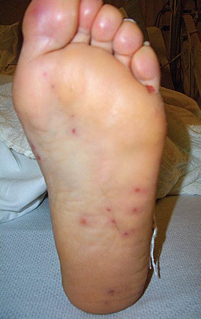 Osler Nodes Endocarditis