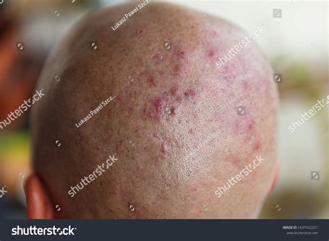 4 321 Scalp Disease Images Stock Photos Vectors Shutterstock