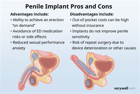 Penile Implant Pros And Cons Of Surgery To Consider