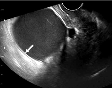 Figure 2 From [a Case Of Ileal Duplication Cyst Lined By Ciliated Columnar And Squamous