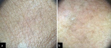 Evolution And Principles Of Dermoscopy Cosmoderma