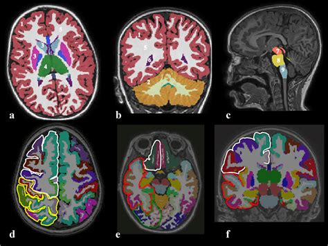 Automatic Volume Segmentation Of Cortical Subcortical Structures And