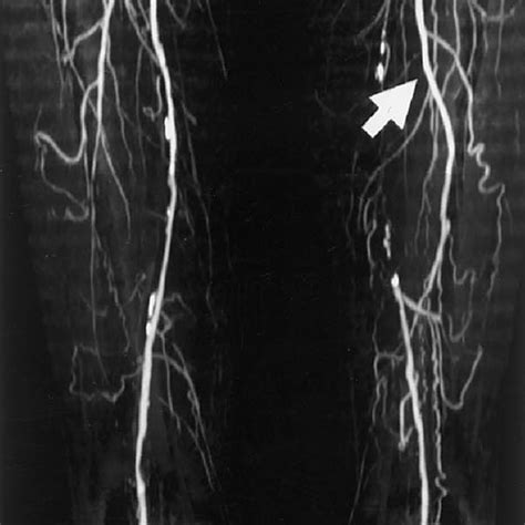 Pdf Multi Detector Row Ct Angiography Of Lower Extremity Arterial Inflow And Runoff Initial