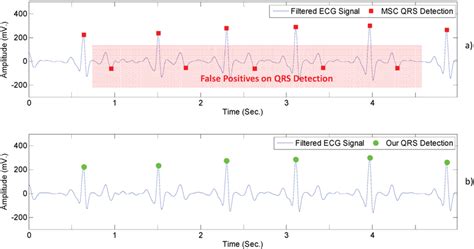 Ecg Signals From Ds2 A Filtered Ecg Signals With Their Qrs Positions