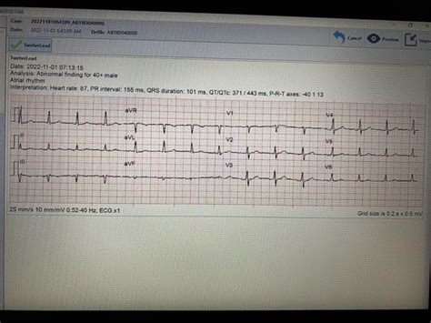 63 Y O In Svt Converted Via Modified Valsalva Maneuver R Ecg