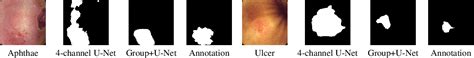 Figure 3 From Fully Automated Semantic Segmentation Of Wireless Capsule Endoscopy Abnormalities